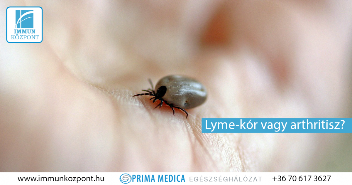 Lyme-kór eredetű ízületi gyulladás, vagy arthritisz?
