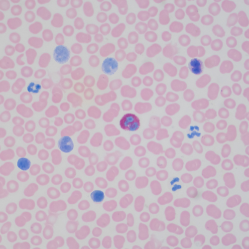 AIHA-Autoimmun hemolitikus anémia-Immun Központ